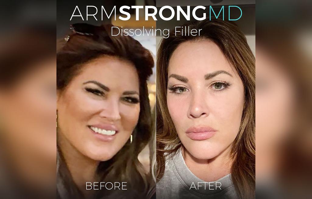 Emily Simpson Debuts Drastic New Face Ahead Of 'RHOC' Season 16 ...