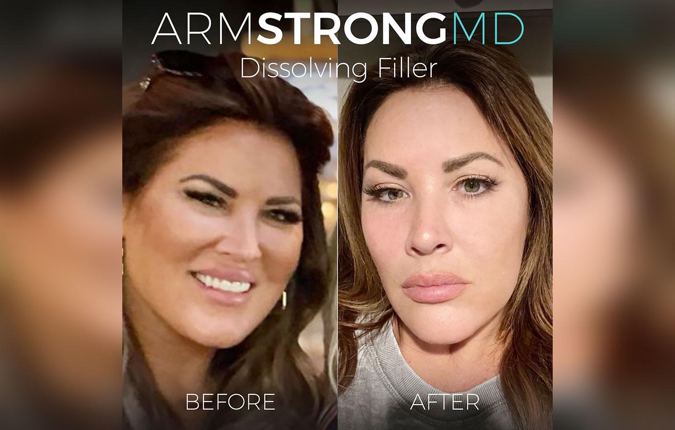 Emily Simpson Debuts Drastic New Face Ahead Of 'RHOC' Season 16 ...